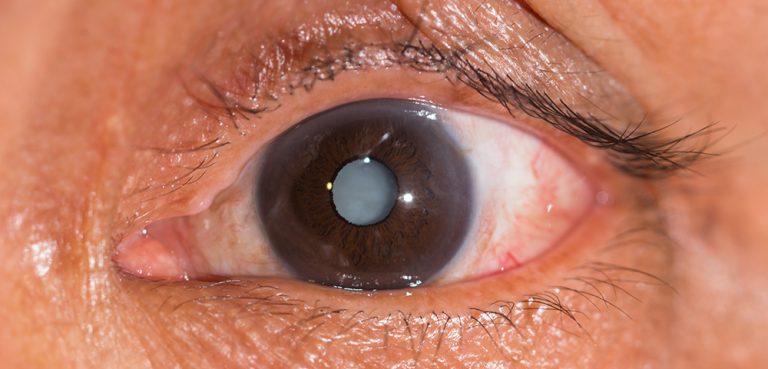 Cataract: oorzaak, symptomen en behandeling - OgenBlik